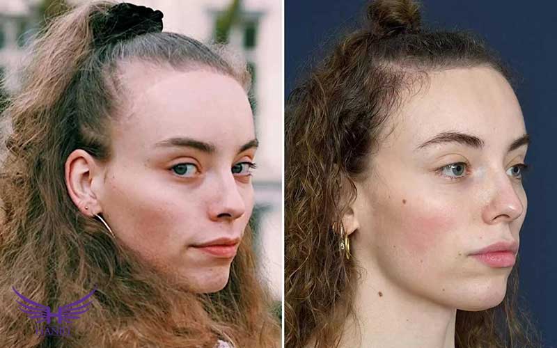 آشنایی با انواع روش های کاشت مو | DHI ،FUE و FUT - کلینیک زیبایی هانیل